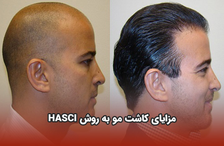 کاشت مو به روش hasci | کاشت سلول ساقه ی مو (HASCI) | تکنیک HSI کاشت مو ...