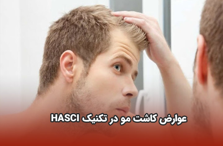 کاشت مو به روش hasci | کاشت سلول ساقه ی مو (HASCI) | تکنیک HSI کاشت مو ...