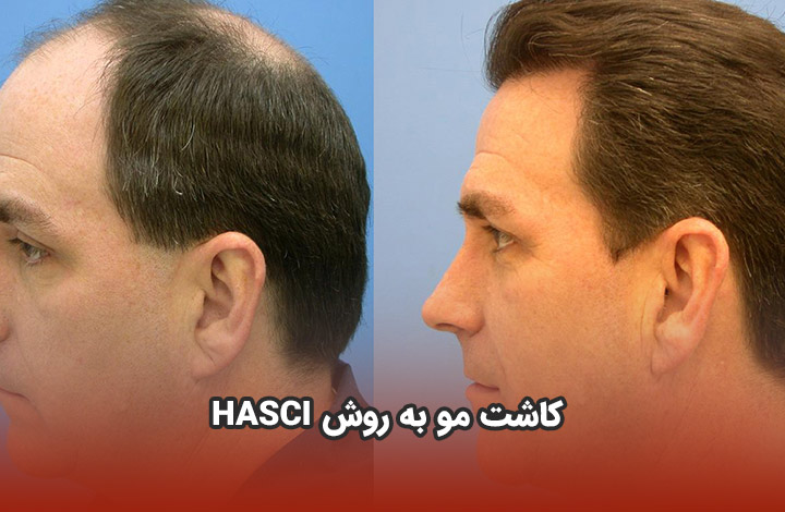 کاشت مو به روش hasci | کاشت سلول ساقه ی مو (HASCI) | تکنیک HSI کاشت مو ...