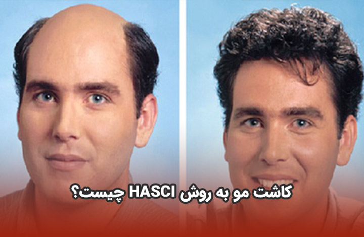 کاشت مو به روش hasci | کاشت سلول ساقه ی مو (HASCI) | تکنیک HSI کاشت مو ...